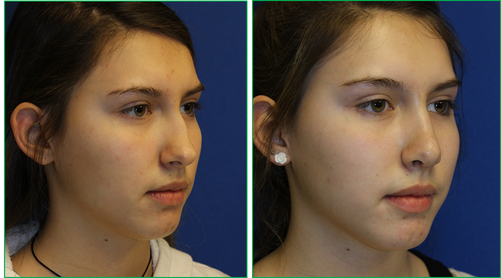 Best Rhinoplasty Surgeon in Noida - The Skin Smiths Clinic